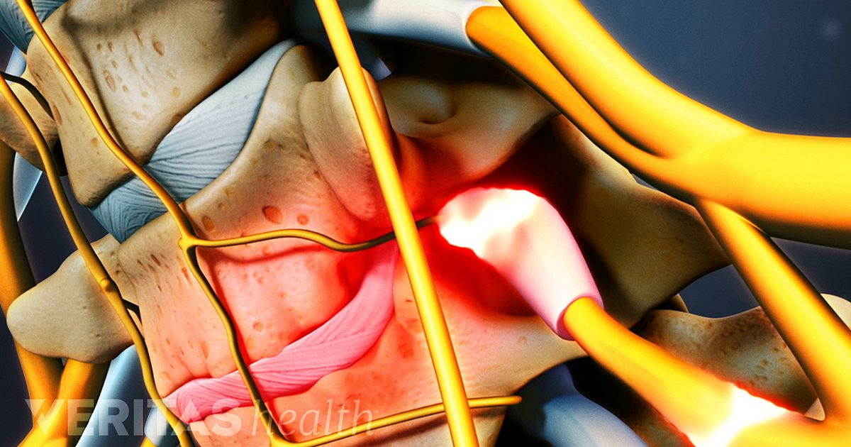 Cervical Selective Nerve Root Block Video