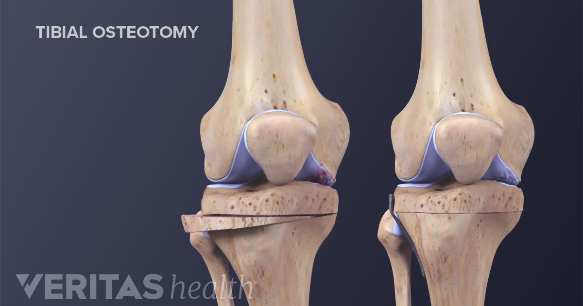 Knee Osteotomy Recovery