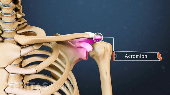 A Visual Guide To Shoulder Ac Joint Arthritis