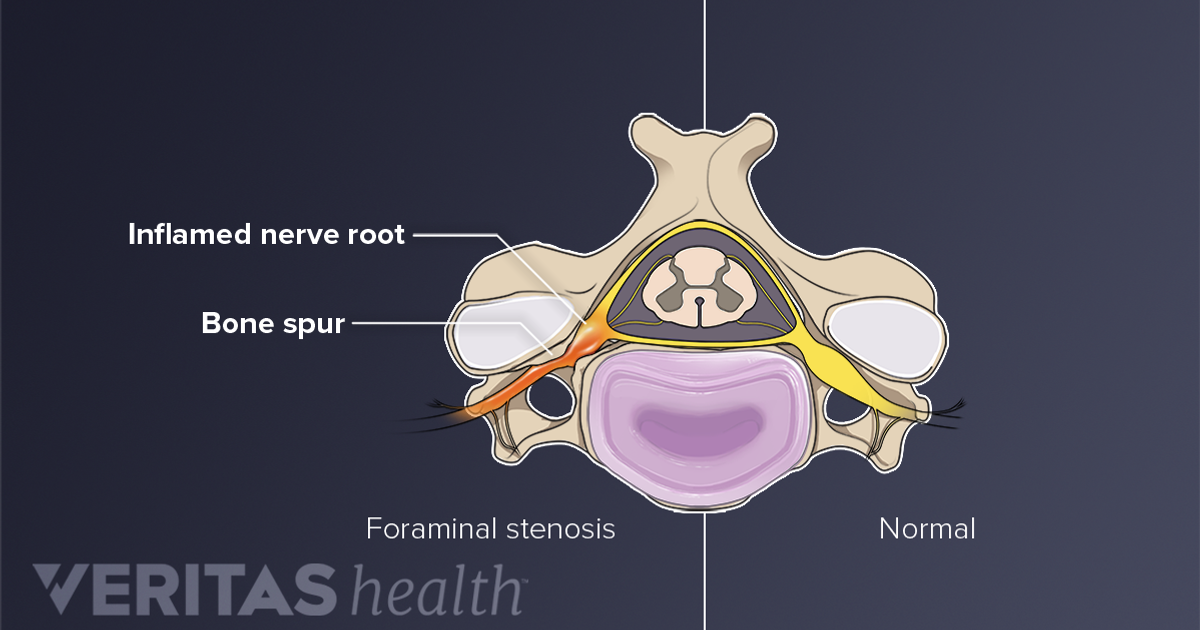 Cervical Radiculopathy Causes And Risk Factors