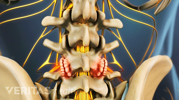 What Are Lumbar Osteophytes Bone Spurs