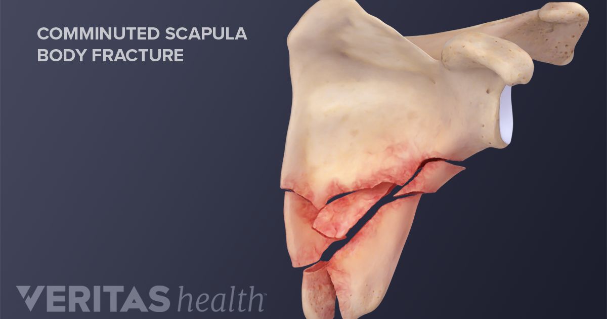 Comminuted Fracture Causes Symptoms And Treatment