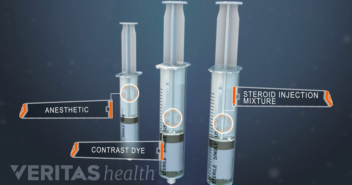How Epidural Steroid Injections Work