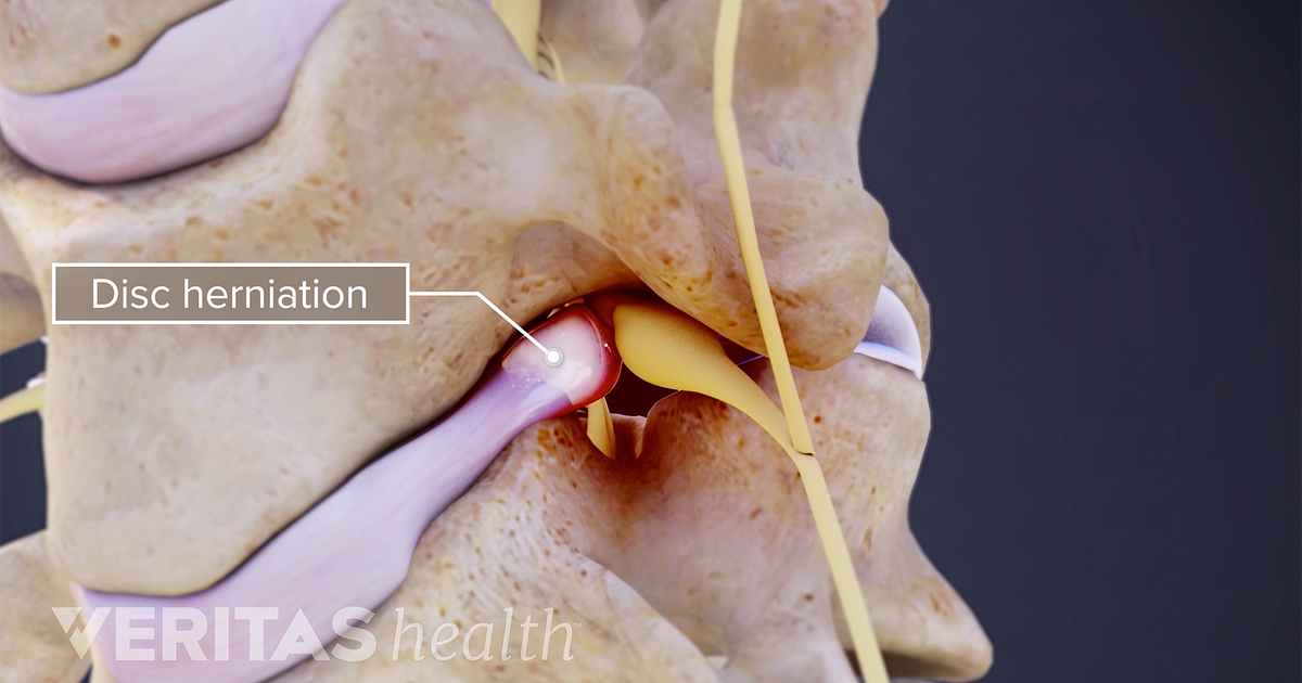 Herniated Disc Definition | Back Pain and Neck Pain Medical Glossary Herniated Disc Definition | Back Pain and Neck Pain Medical Glossary