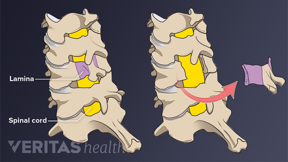 Posterior Cervical Laminectomy