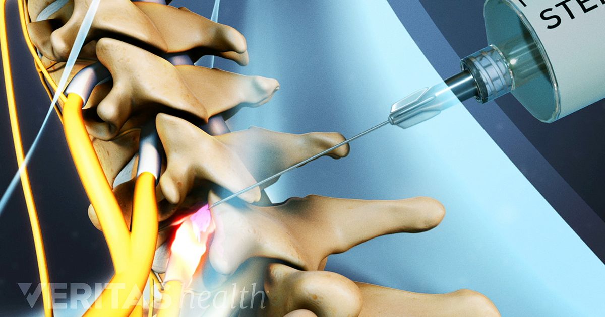 Epidural Nerve Block Injections