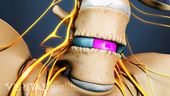 Anterior Lumbar Interbody Fusion Alif Surgery