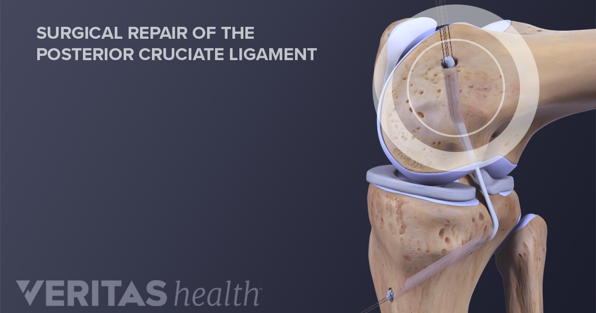 Posterior Cruciate Ligament Pcl Tear Treatment Options