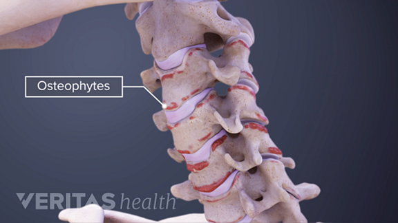 Cervical Osteophytes Treatment Options