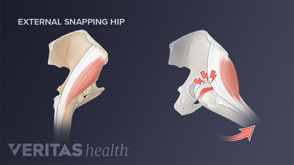 3 Types Of Snapping Hip Syndrome