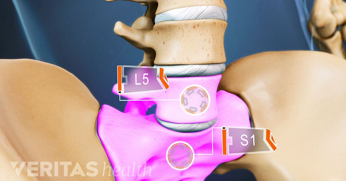 Todo sobre el segmento vertebral L5-S1 (articulación lumbosacra) Todo sobre el segmento vertebral L5-S1 (articulación lumbosacra)