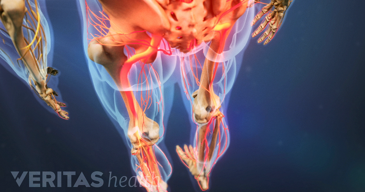 Lumbar Radiculopathy