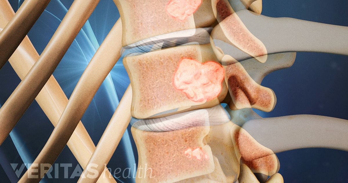 Metastatic Spinal Tumor Symptoms