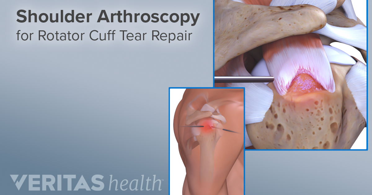 Preparing For Rotator Cuff Surgery